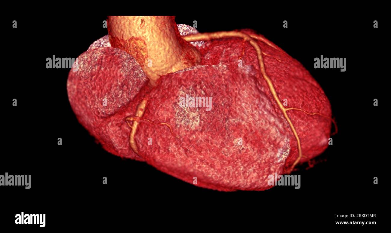 CT Cardiac 3D rendering or CTA coronary artery for prevention coronary ...