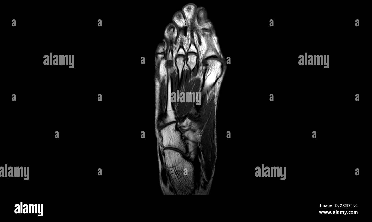 MRI FOOT scan Coronal view T2 technique for diagnostic tendon injury ...