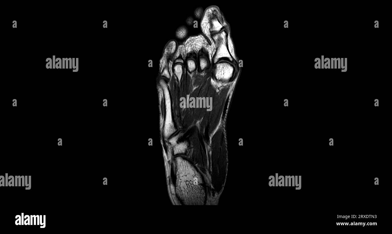 MRI FOOT scan Coronal view T2 technique for diagnostic tendon injury ...