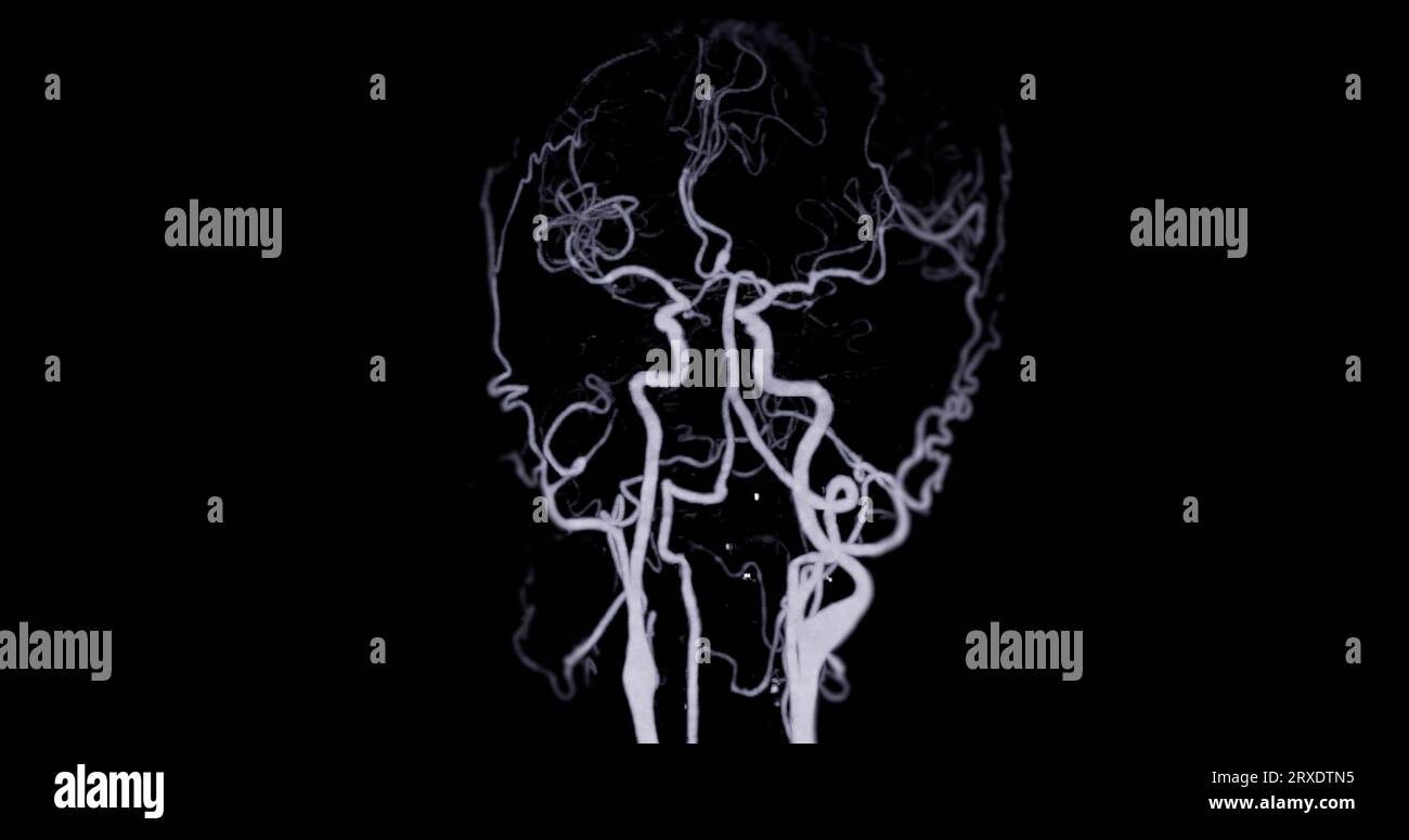 CTA BRAIN or CT angiography of the brain MIP technique image AP and ...