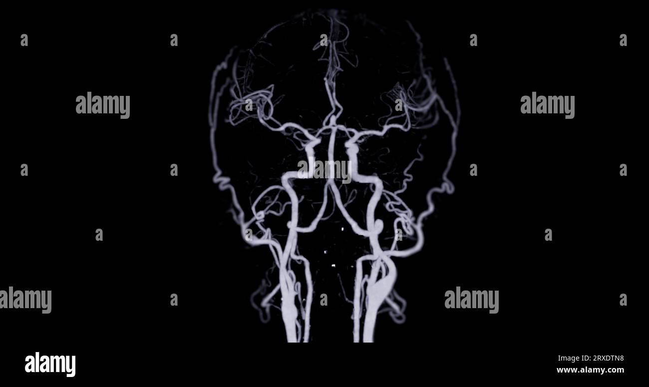 CTA BRAIN or CT angiography of the brain MIP technique image AP and ...