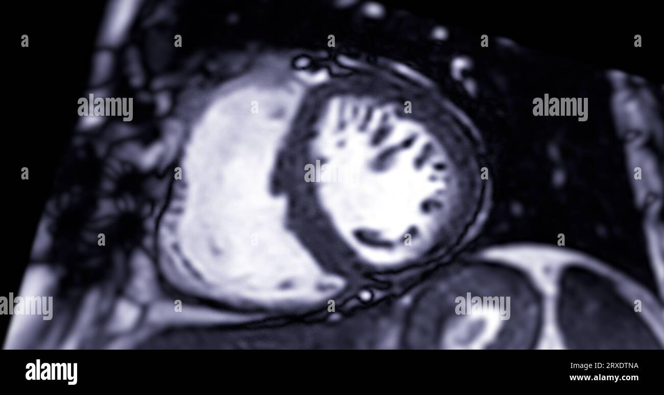 MRI heart or Cardiac MRI ( magnetic resonance imaging ) of heart in ...
