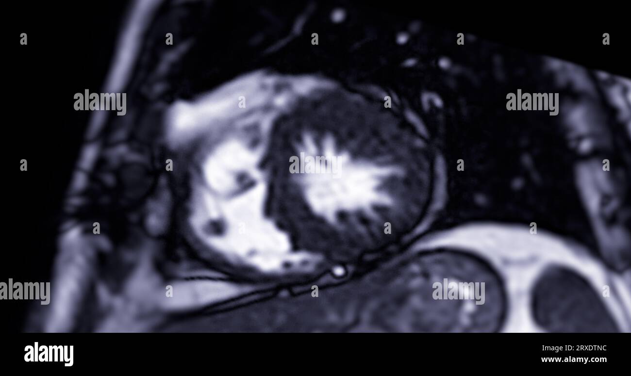 MRI heart or Cardiac MRI ( magnetic resonance imaging ) of heart in ...