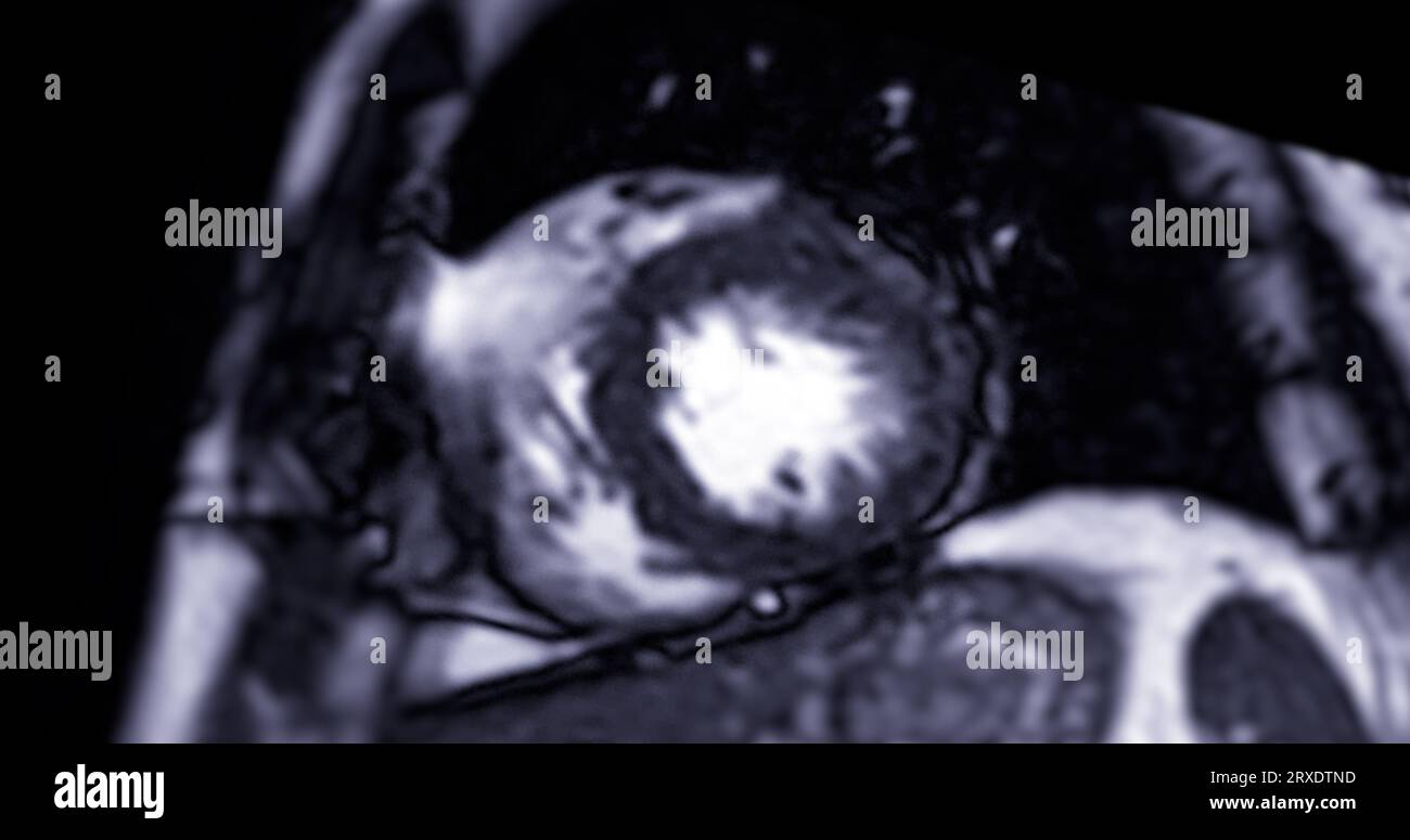 MRI heart or Cardiac MRI ( magnetic resonance imaging ) of heart in ...