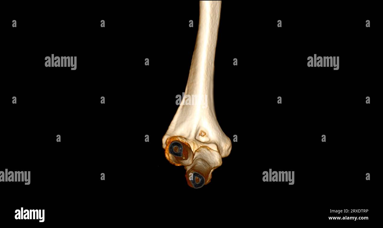 CT scan of elbow joint 3d rendering showing humerus bone Stock Photo ...