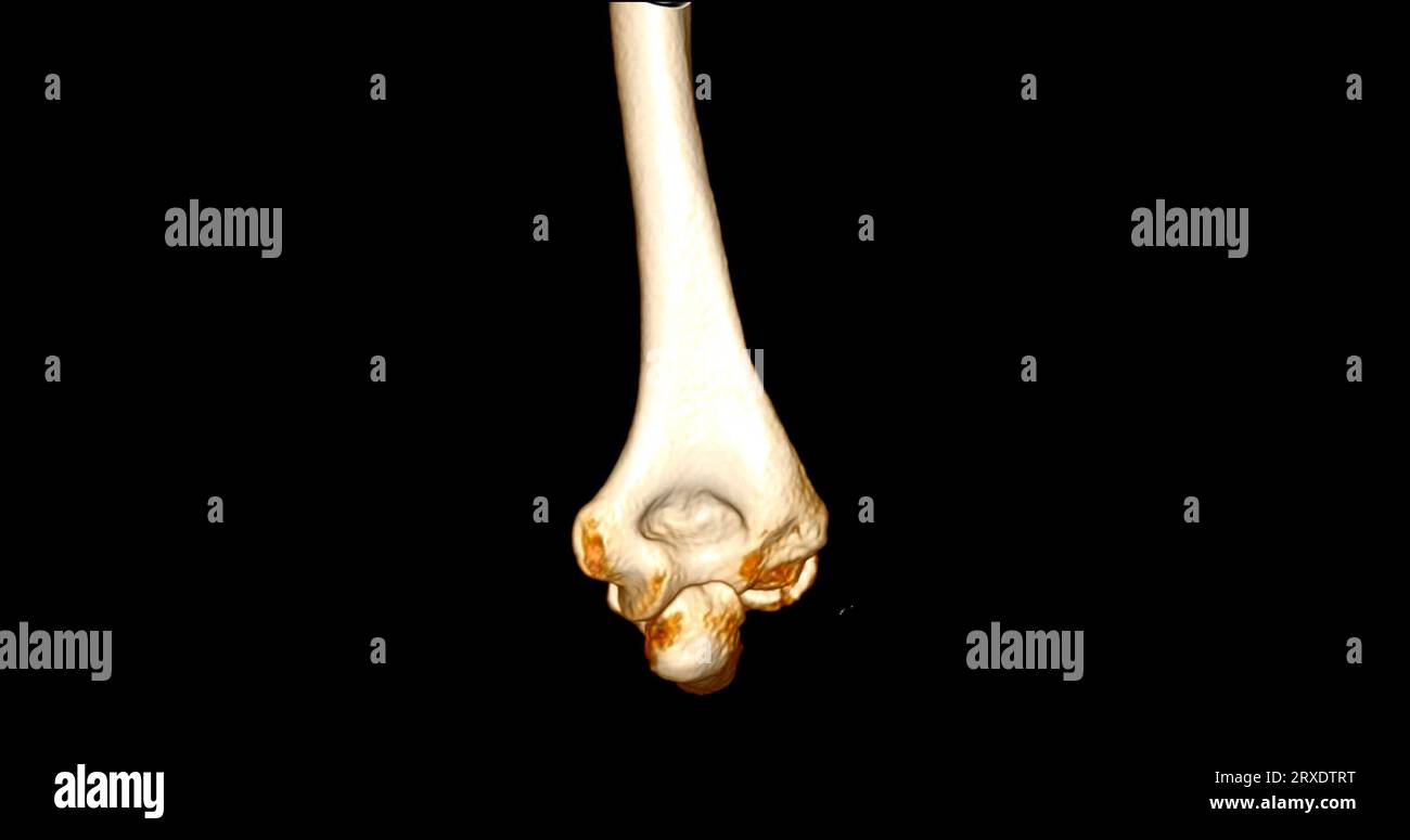 CT scan of elbow joint 3d rendering showing humerus bone Stock Photo ...