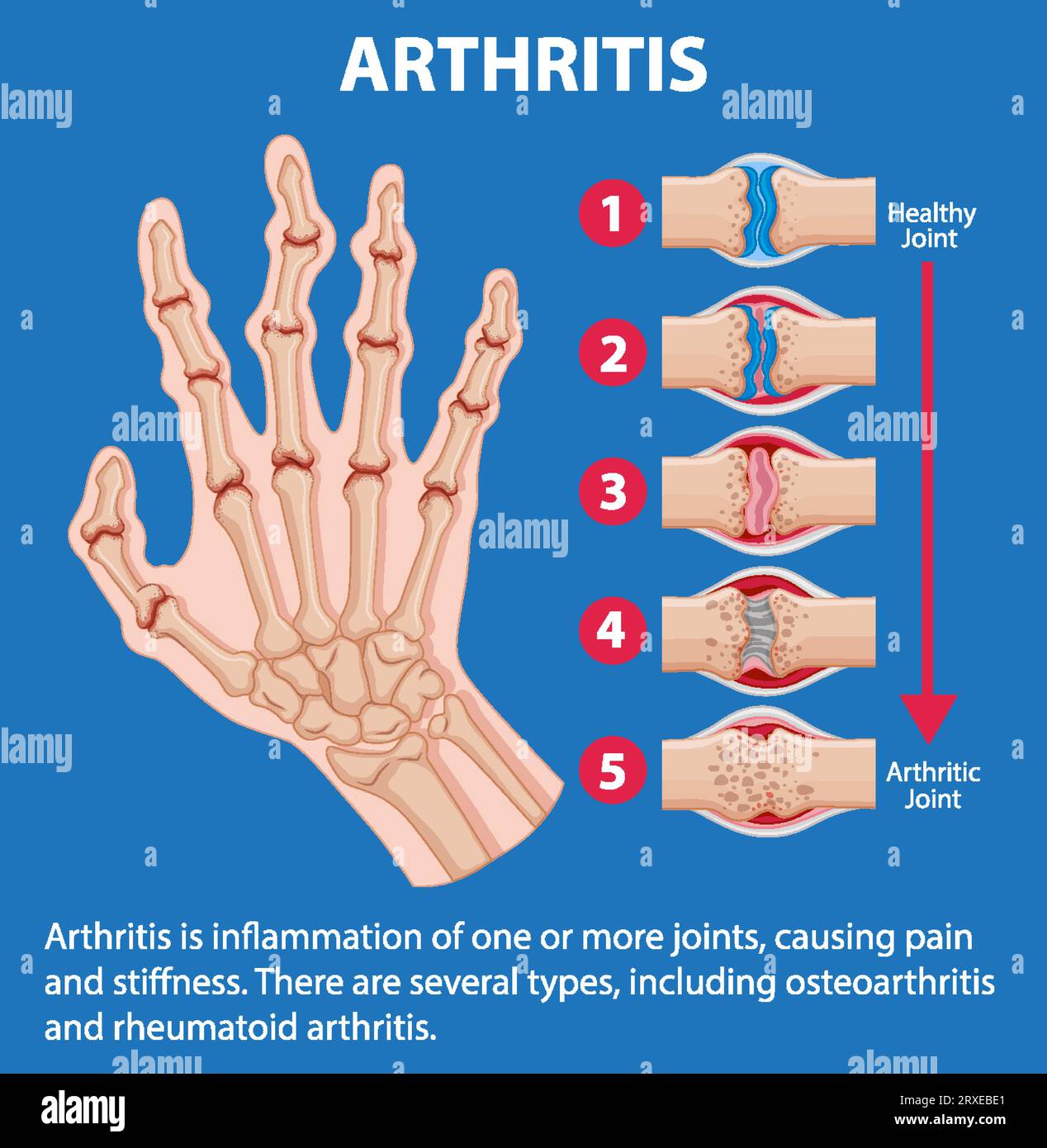 Is Arthritis Hereditary In Humans at Francis Manley blog