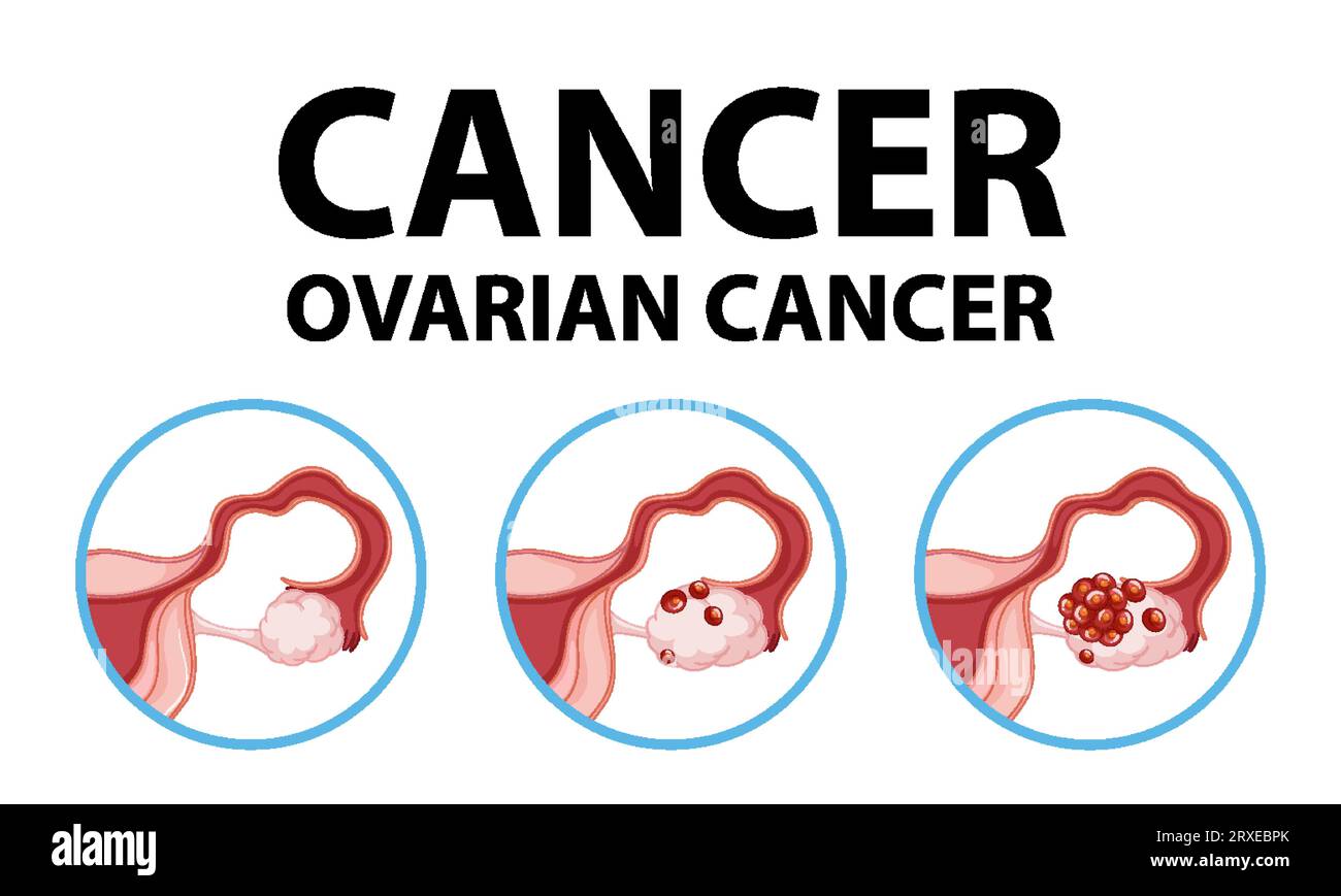 Illustrated infographic highlighting the medical anatomy of ovarian ...
