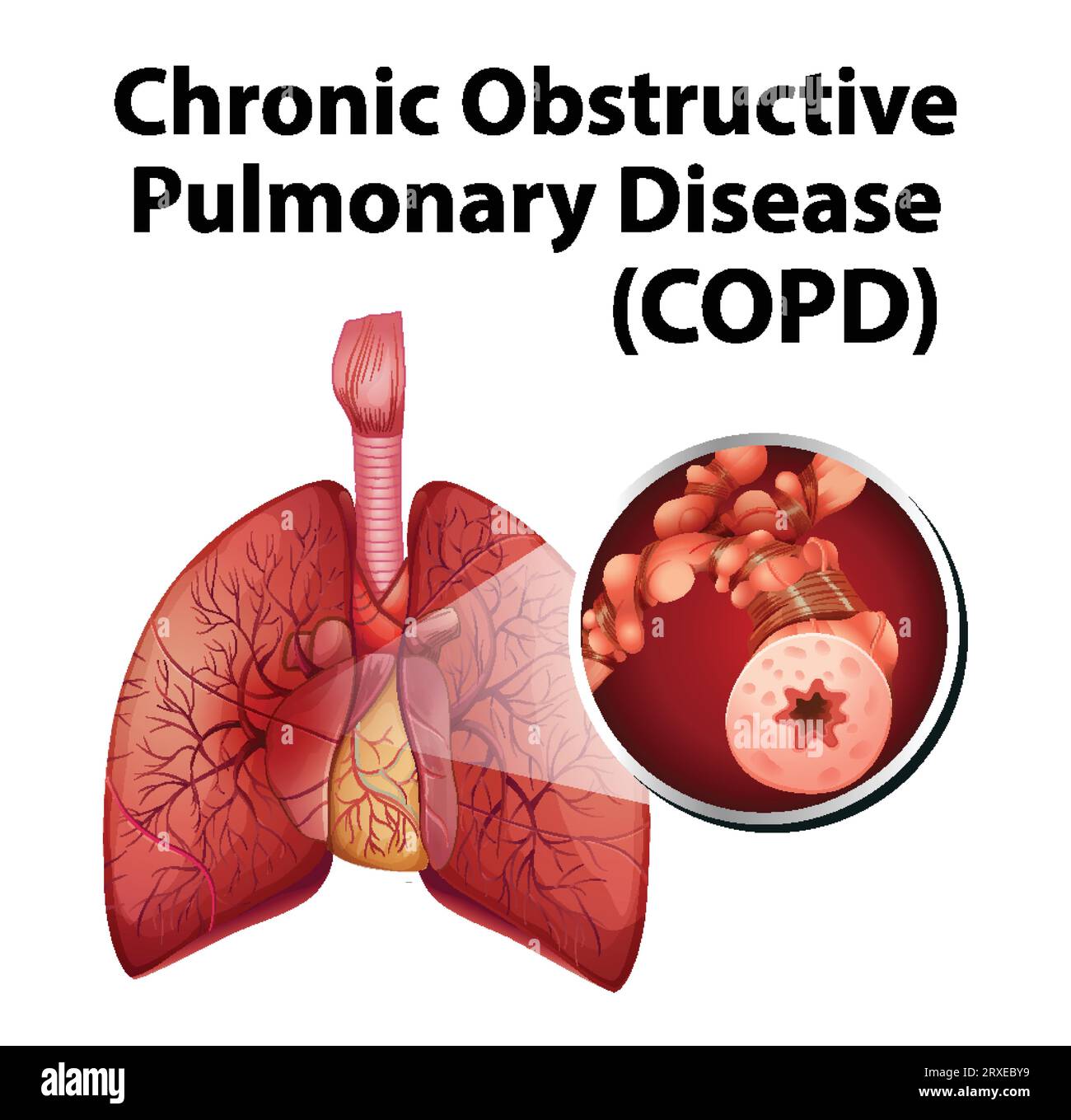 Illustrated infographic explaining chronic obstructive pulmonary ...