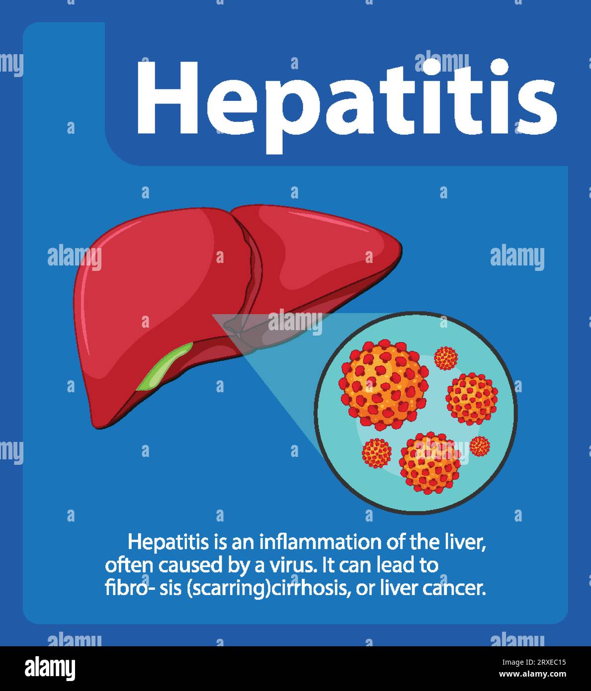 Hepatitis virus infection close up hi-res stock photography and images ...