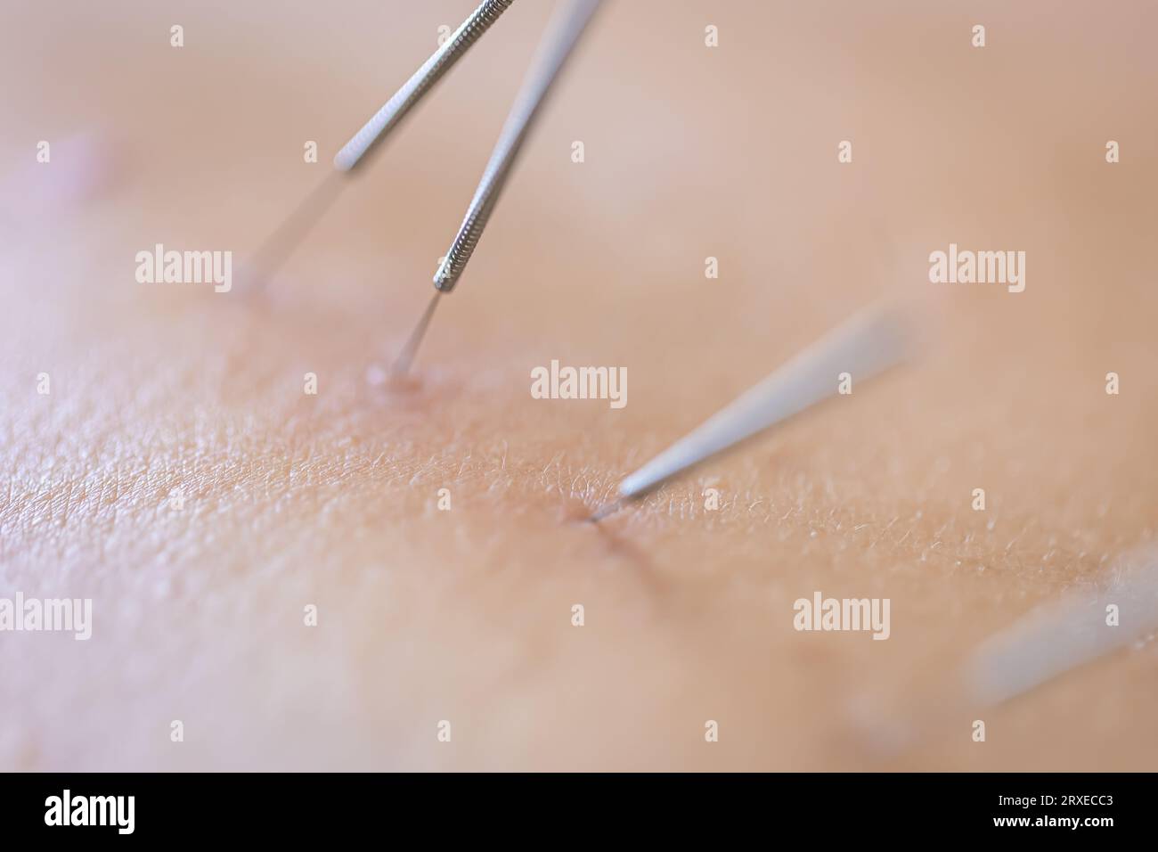 Dry needling acupuncture needles on patient, close up Stock Photo - Alamy