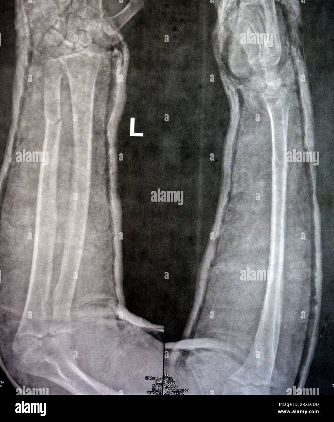 Plain X ray of right forearm (mistakenly written Left on the film ...