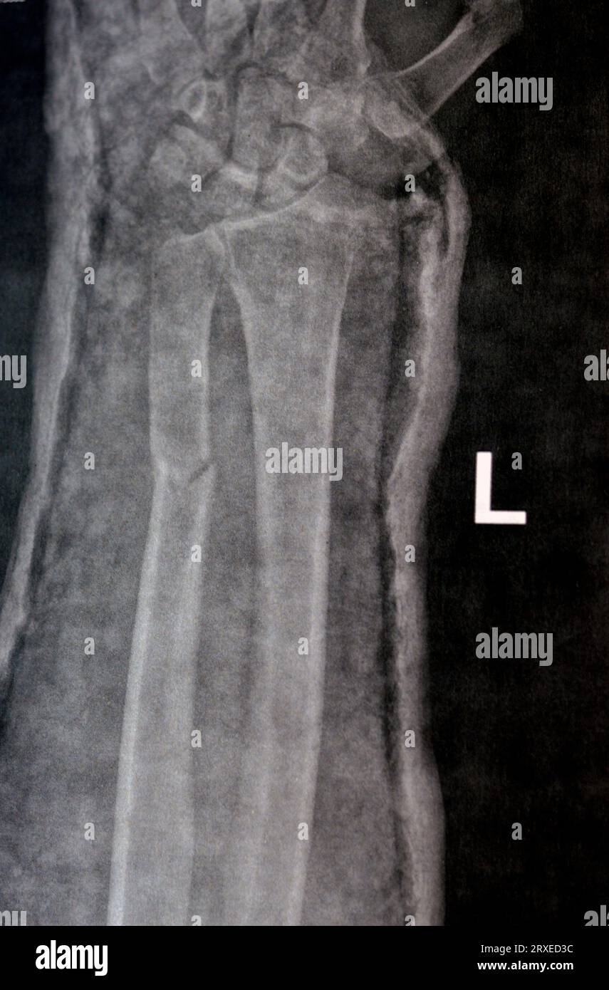 Plain X ray of right forearm (mistakenly written Left on the film ...