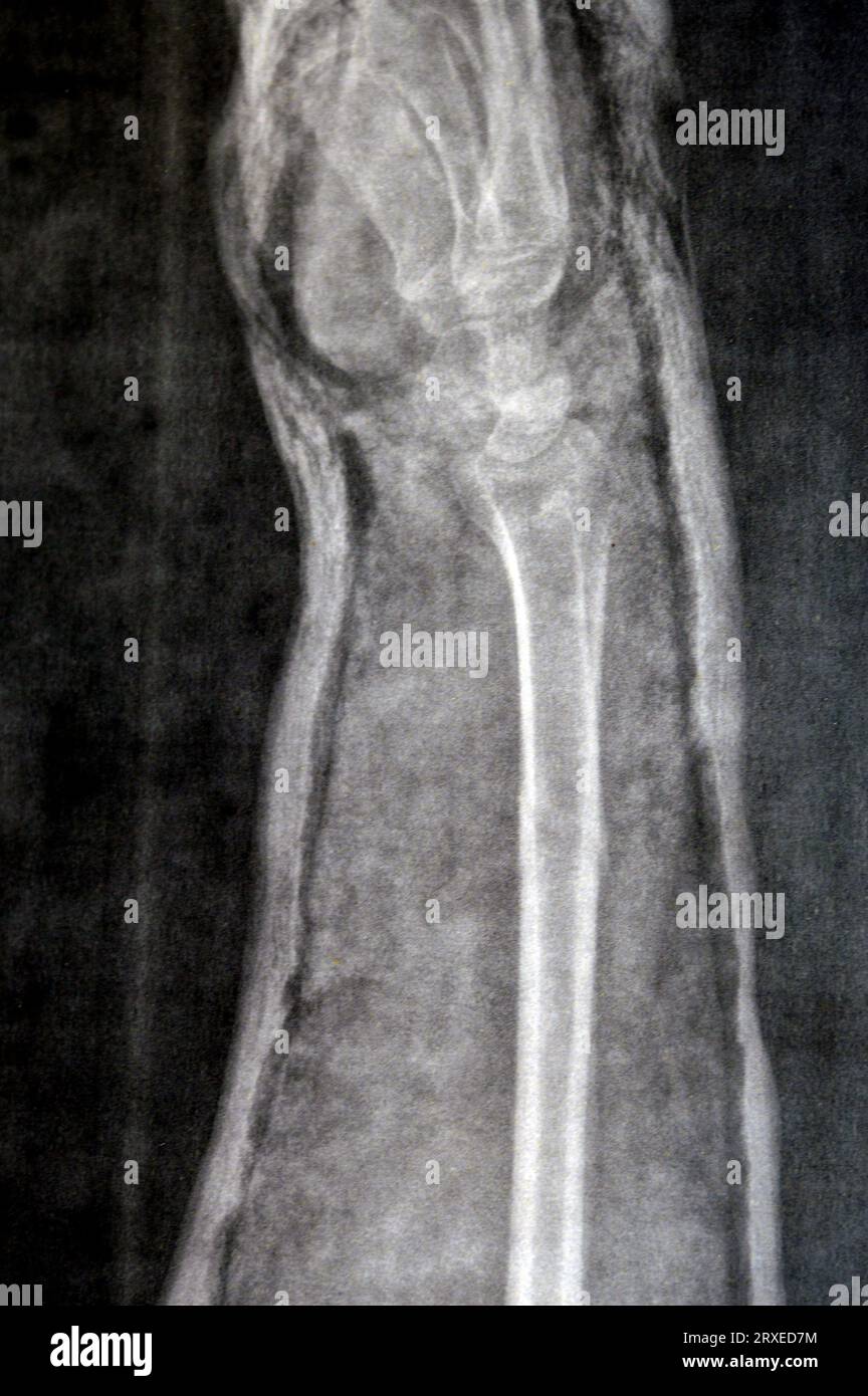 Plain X ray of right forearm (mistakenly written Left on the film ...