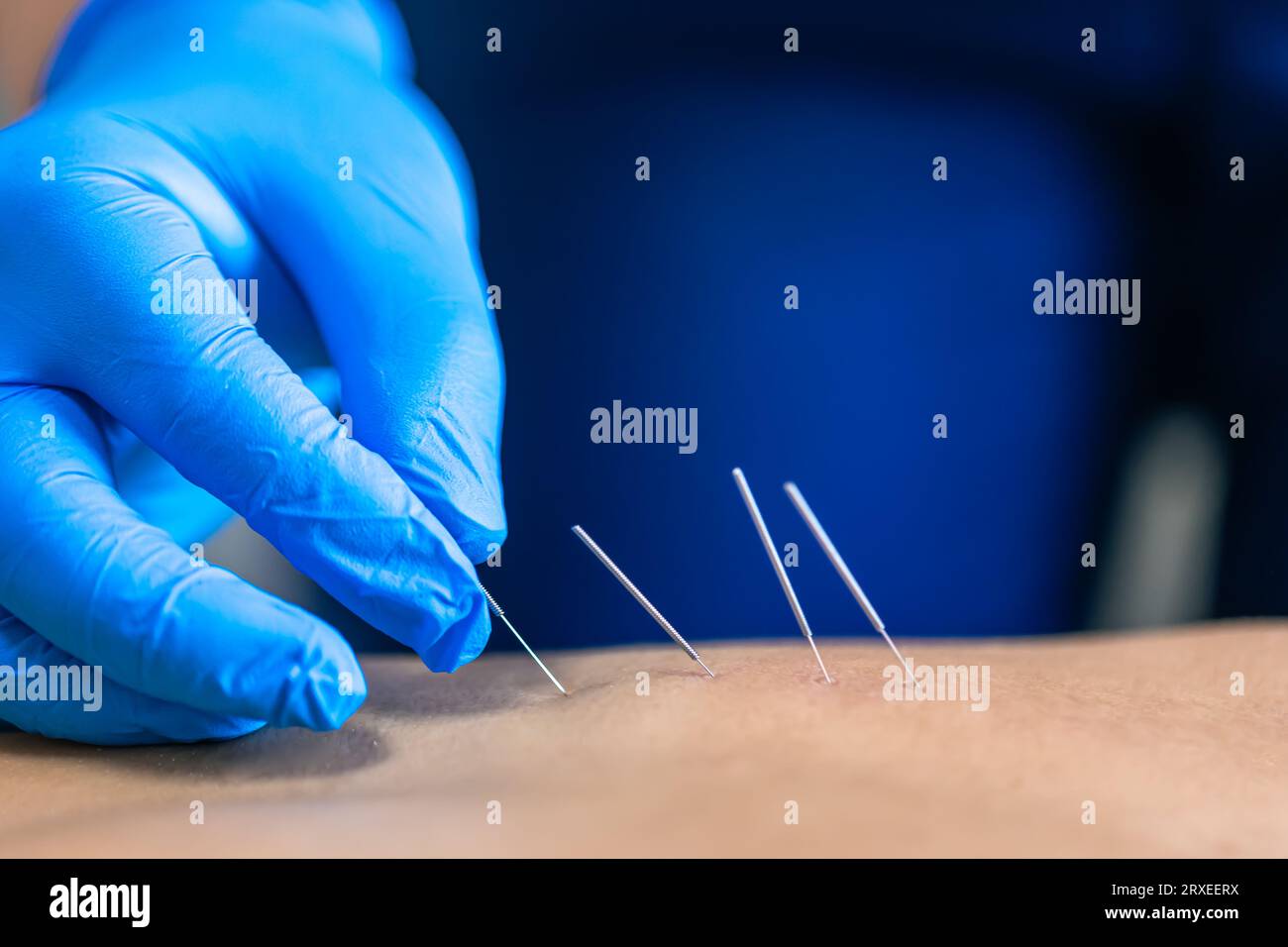 Physio dry needling hi-res stock photography and images - Alamy