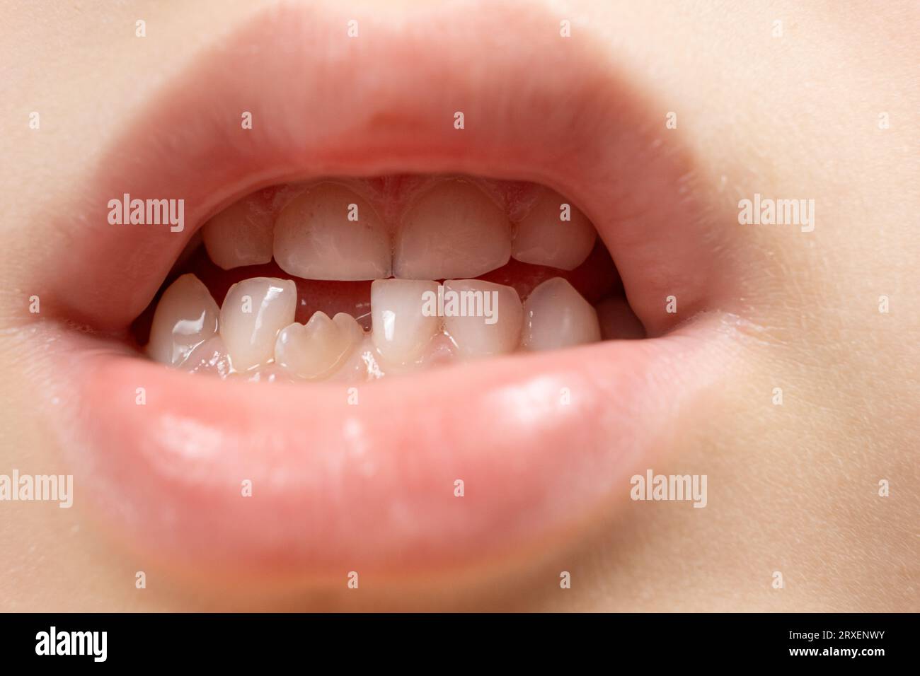 The teeth of a six-year-old child, a crookedly growing incisor in place ...