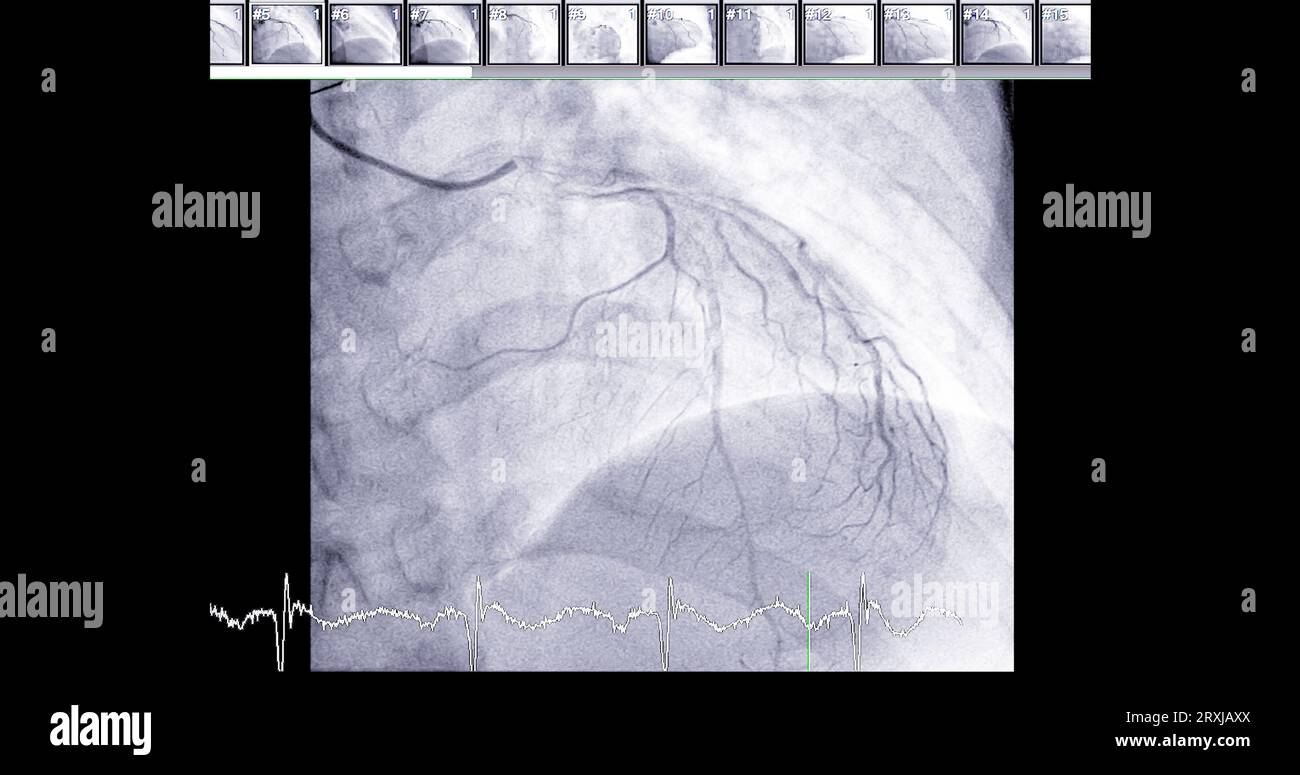 Cardiac catheterization on left anterior descending artery (LAD) can ...