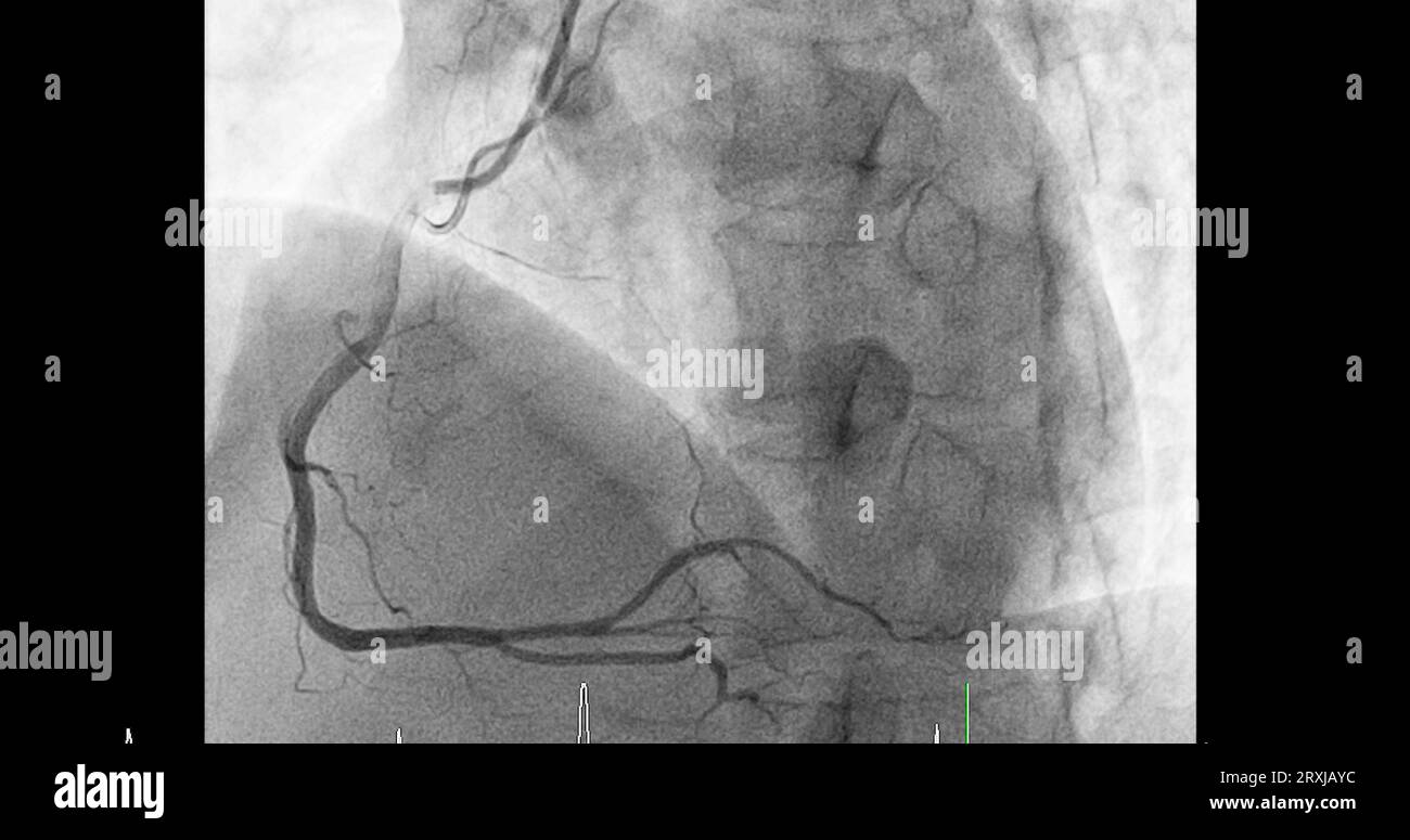 Cardiac catheterization on right coronary artery (RCA) can help doctor ...