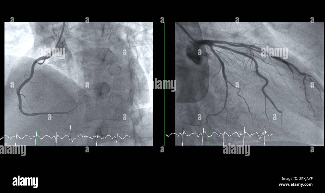 Cardiac catheterization on RCA and LAD can help doctor diagnose and ...