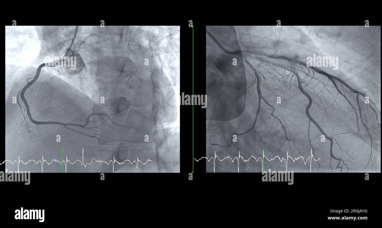 Cardiac catheterization on RCA and LAD can help doctor diagnose and ...