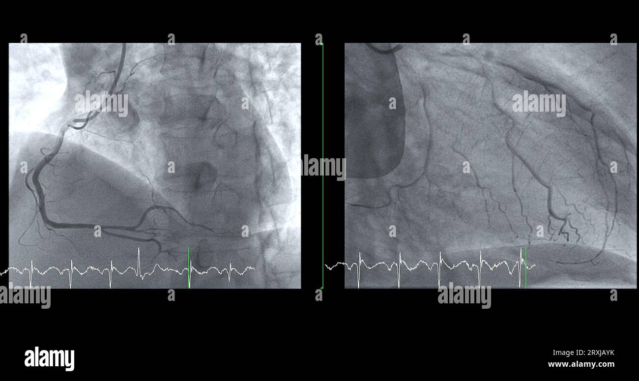 Cardiac catheterization on RCA and LAD can help doctor diagnose and ...