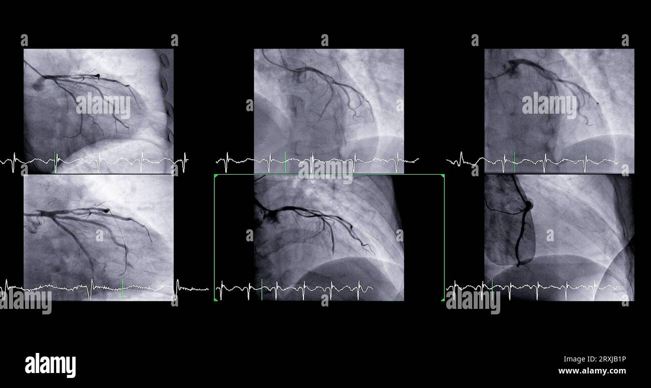 Cardiac catheterization can help doctor diagnose and treat problems in ...