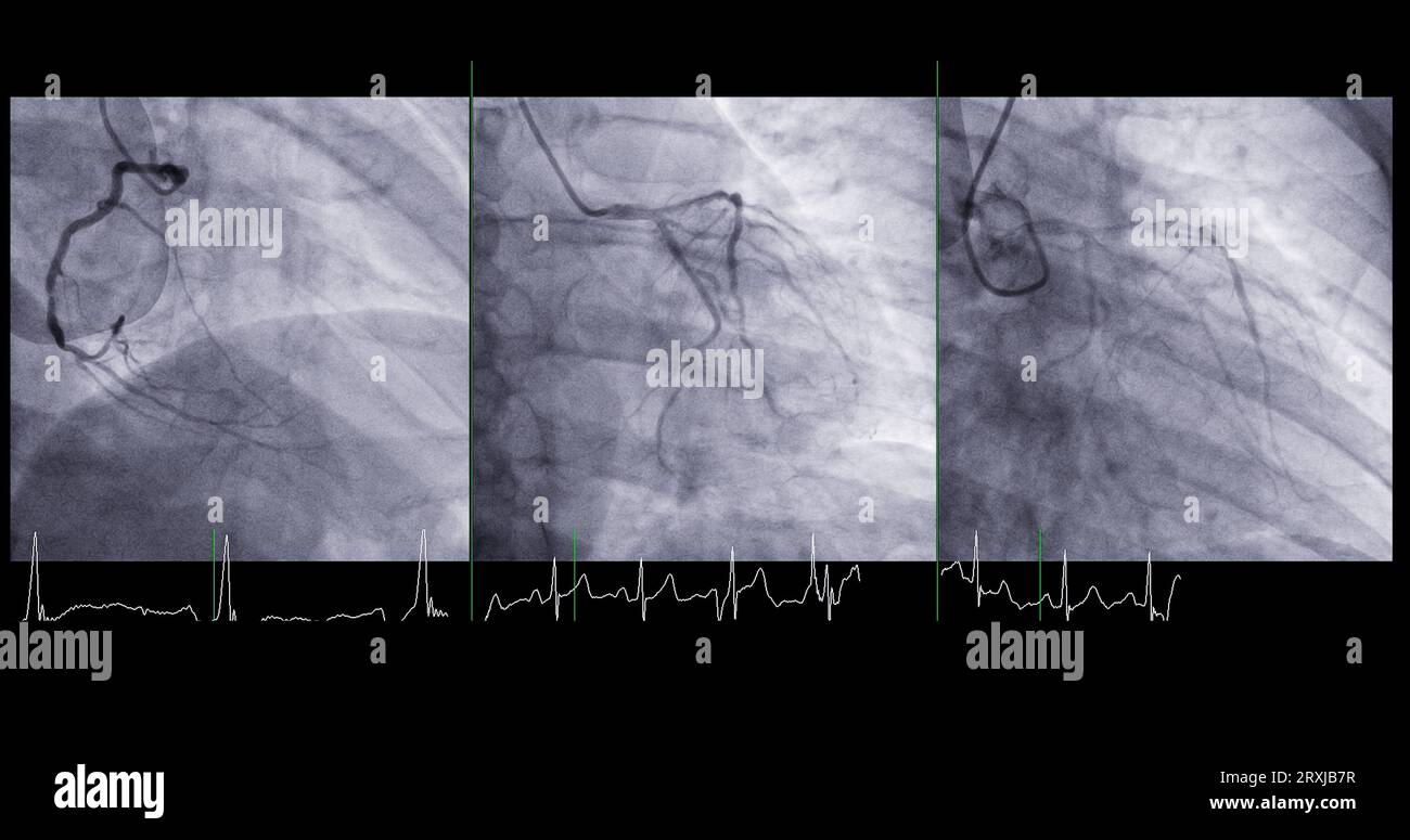 Fluoroscopy heart hi-res stock photography and images - Alamy