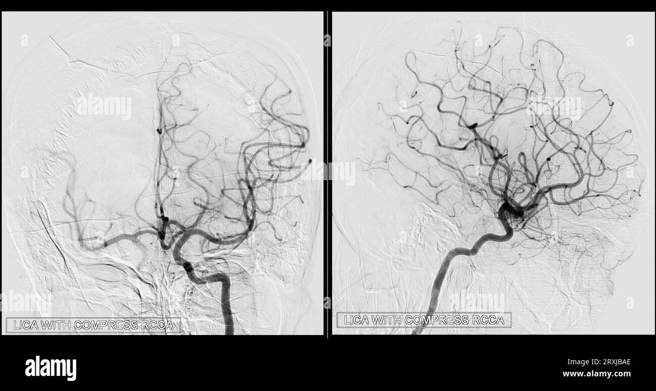 Cerebral angiography image from Fluoroscopy in intervention radiology ...
