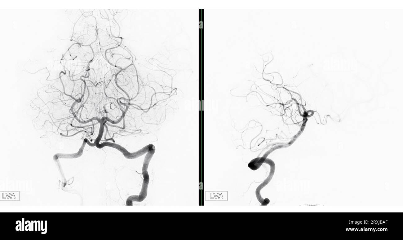 Cerebral angiography image from Fluoroscopy in intervention radiology ...