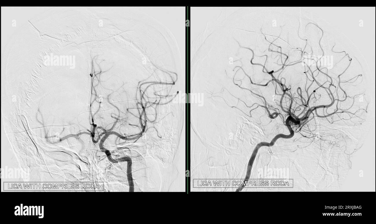 Cerebral angiography image from Fluoroscopy in intervention radiology ...