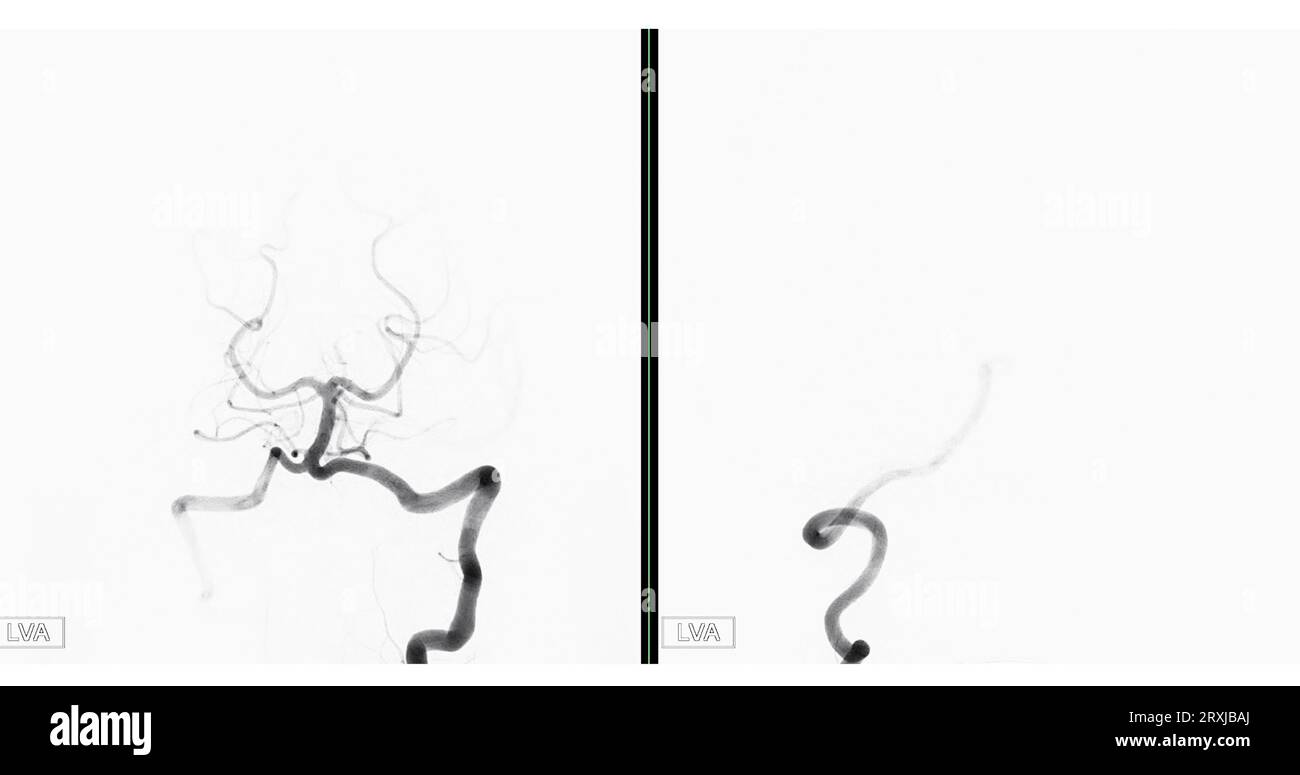 Cerebral angiography image from Fluoroscopy in intervention radiology ...