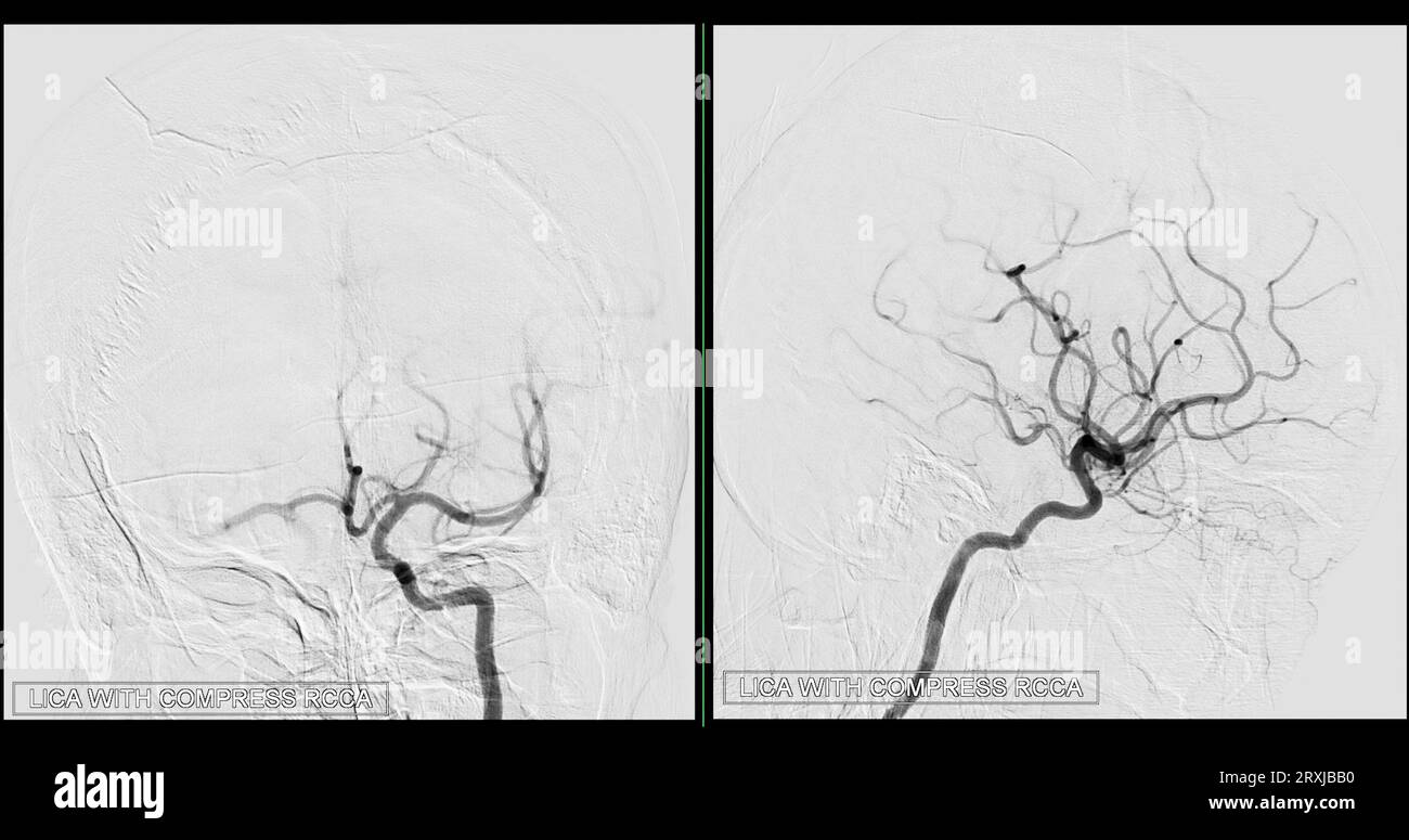 Cerebral angiography image from Fluoroscopy in intervention radiology ...