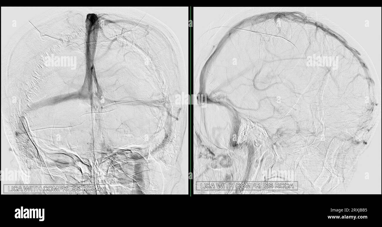 Cerebral angiography image from Fluoroscopy in intervention radiology ...