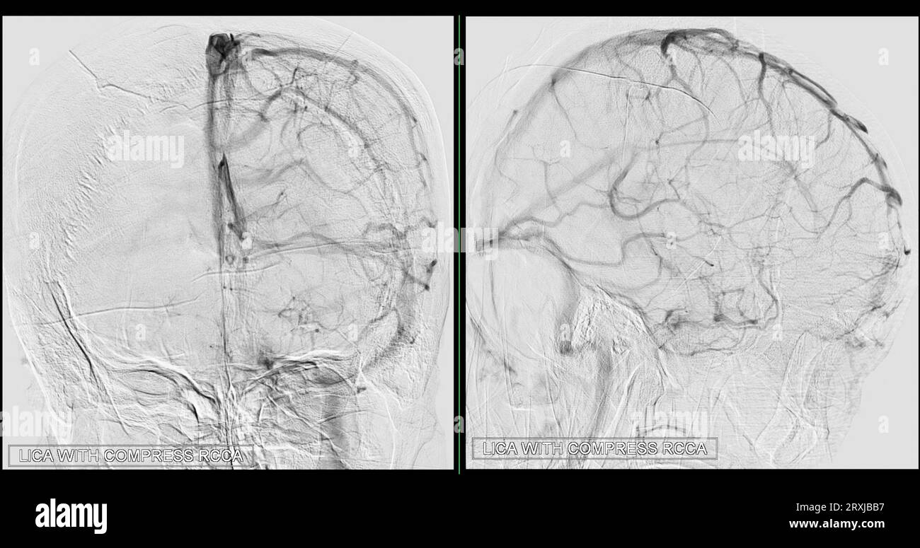 Cerebral angiography image from Fluoroscopy in intervention radiology ...