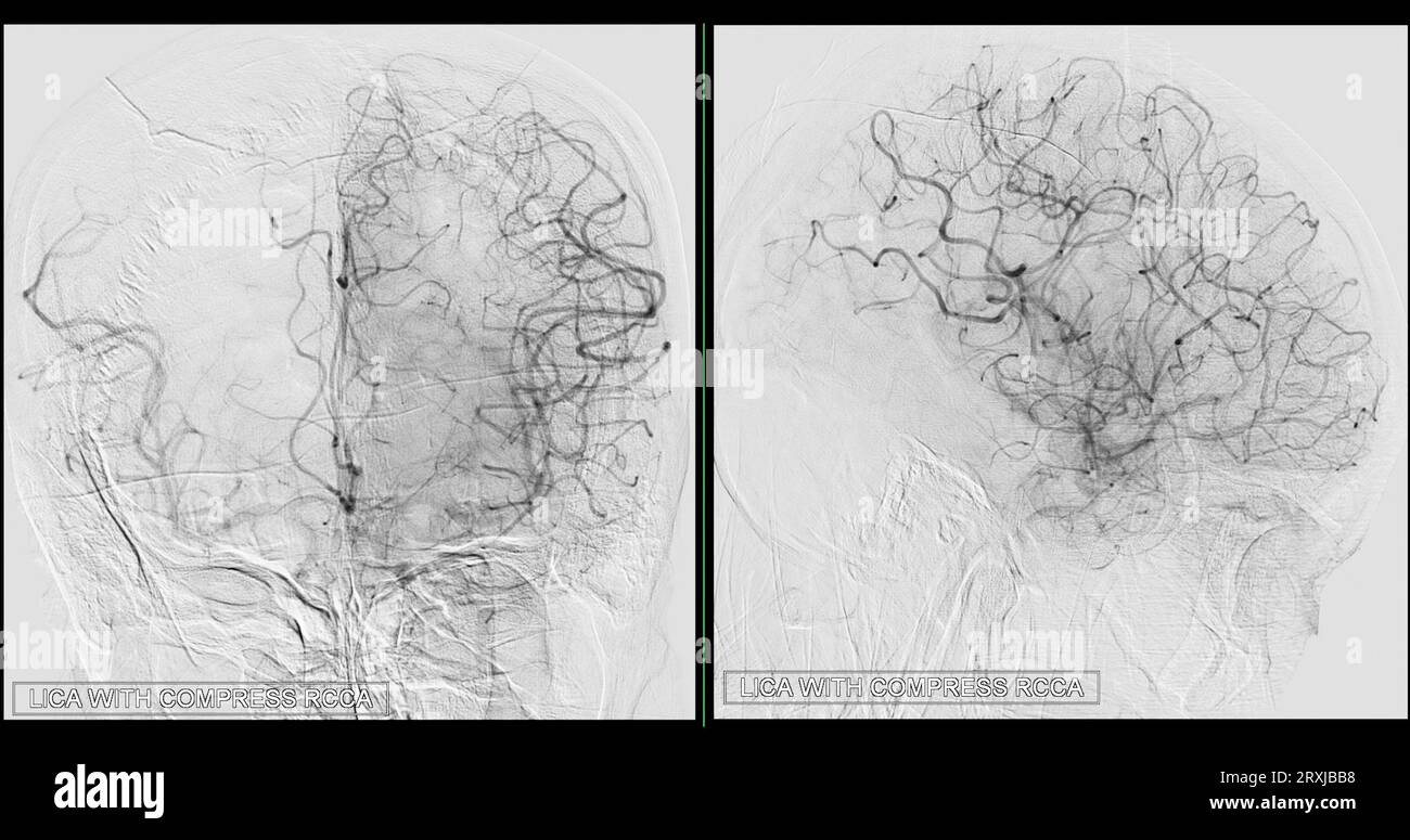 Cerebral angiography image from Fluoroscopy in intervention radiology ...