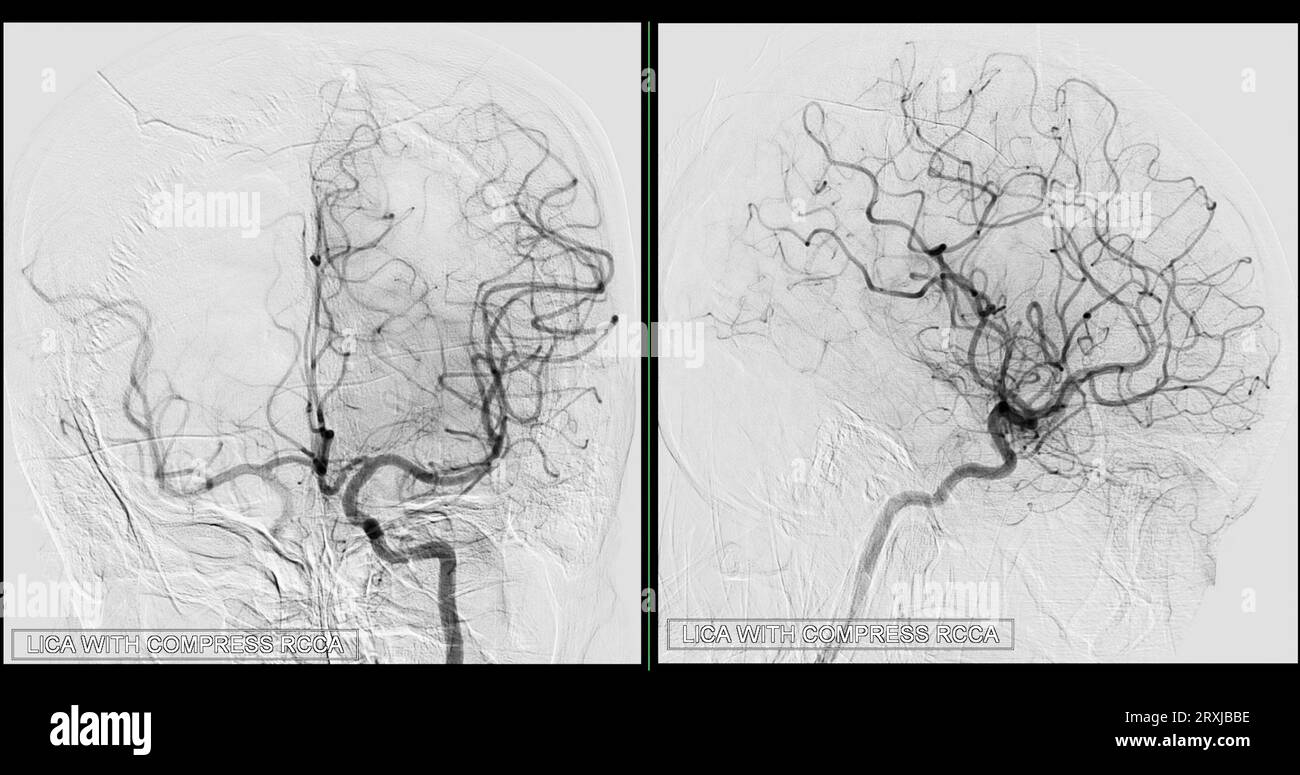 Cerebral angiography image from Fluoroscopy in intervention radiology ...