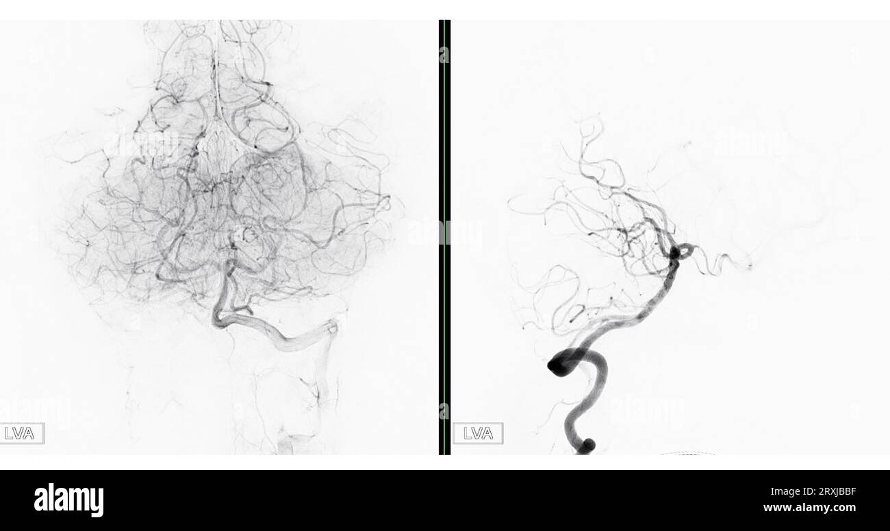 Cerebral angiography image from Fluoroscopy in intervention radiology ...
