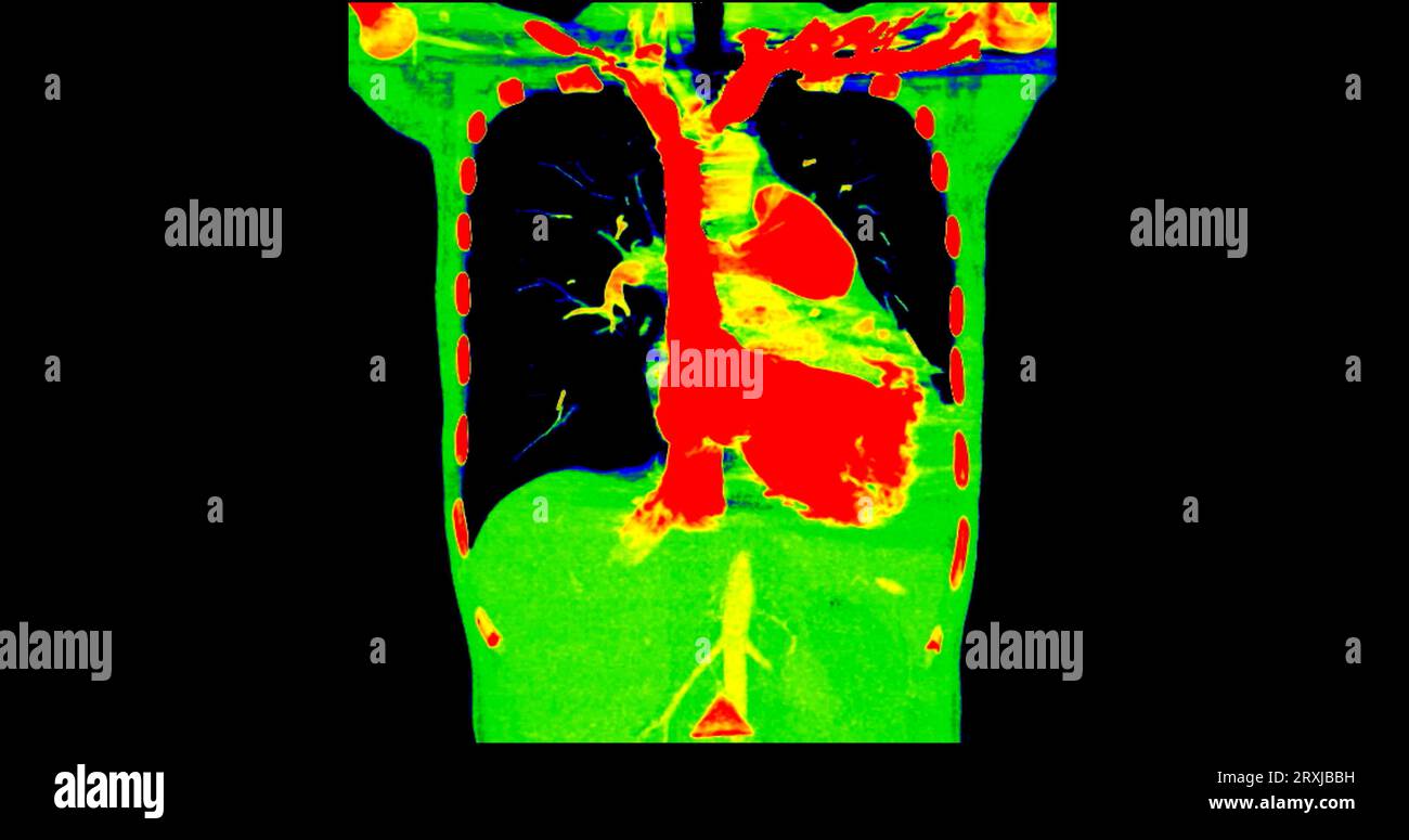 CT scan of Chest coronal view in color mode for diagnostic Pulmonary ...