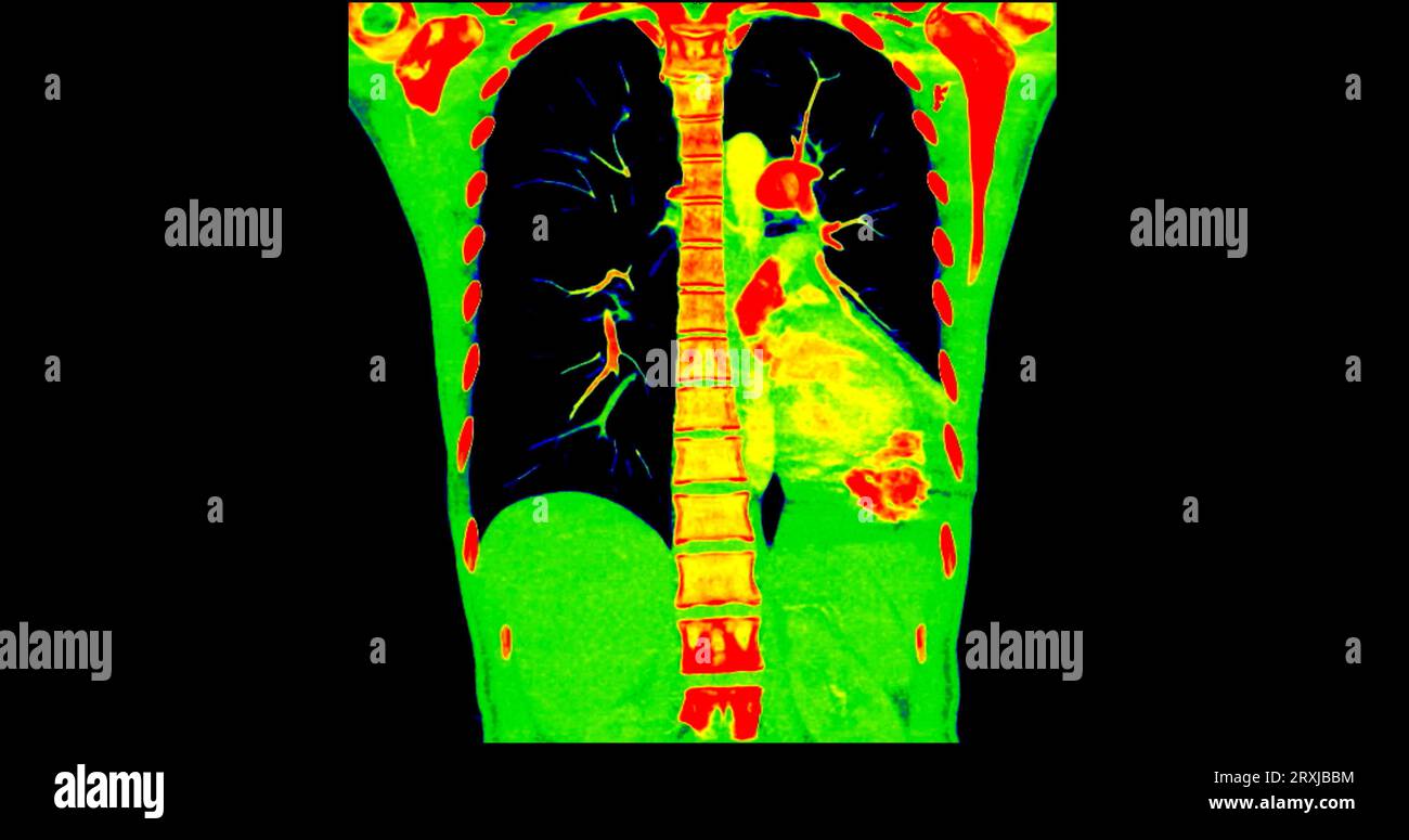 CT scan of Chest coronal view in color mode for diagnostic Pulmonary ...