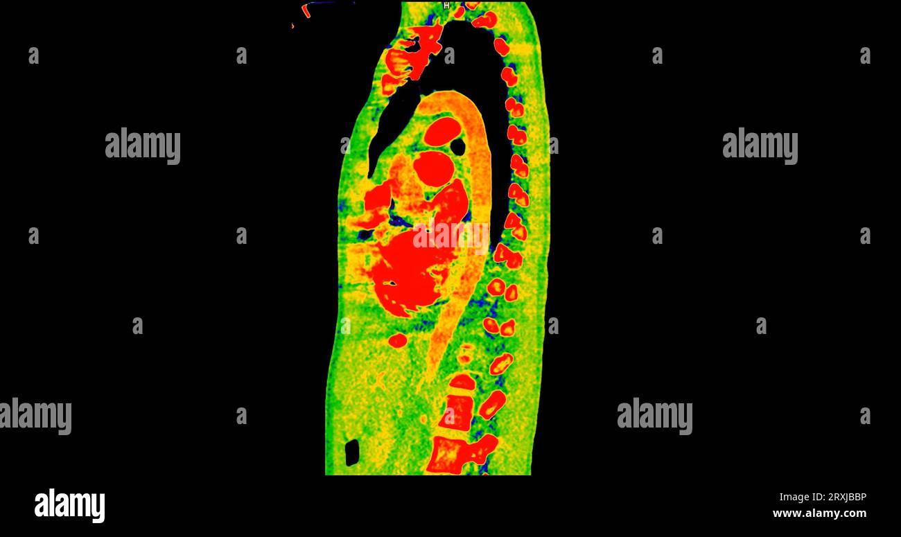 Ct Scan Of Chest Sagittal View In Color Mode For Diagnostic Pulmonary Embolism Pe Lung