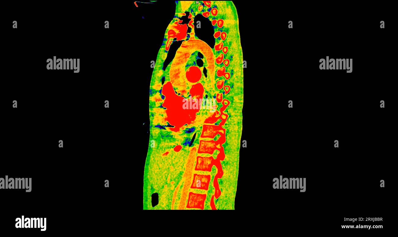 CT scan of Chest sagittal view in color mode for diagnostic Pulmonary ...