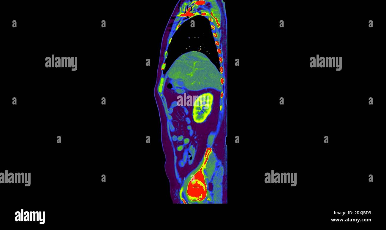 Sagittal Ct Thorax