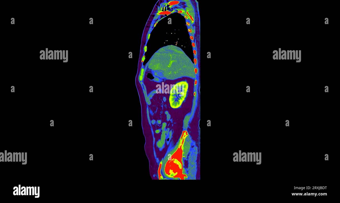 Ct Chest And Abdomen With Injection Contrast Media Sagittal Plane For