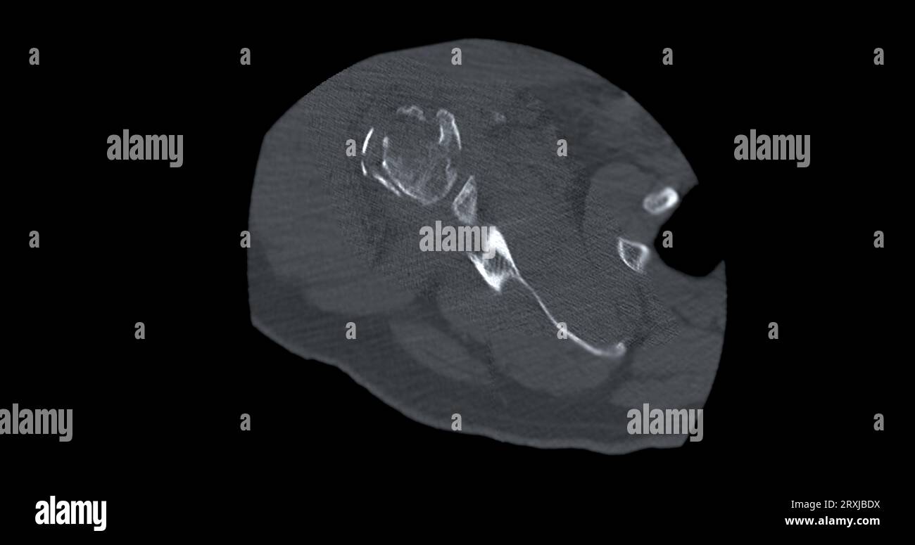 CT Scan of Shoulder joint in case fracture shoulder joint Stock Photo ...