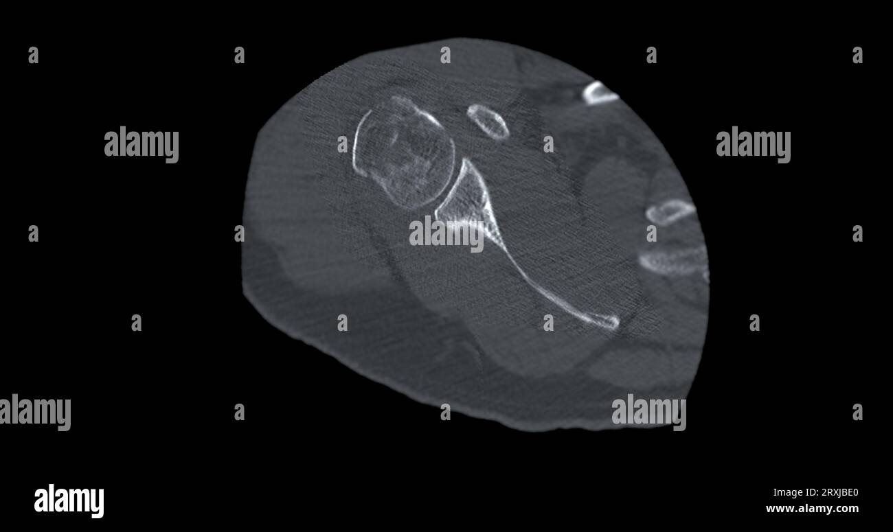 CT Scan of Shoulder joint in case fracture shoulder joint Stock Photo ...