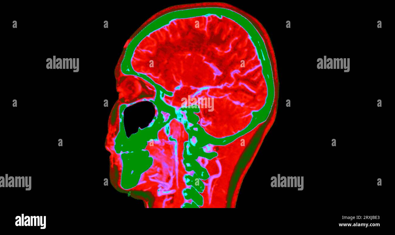 CT angiography of the brain or CTA brain and neck Sagittal view 3D ...