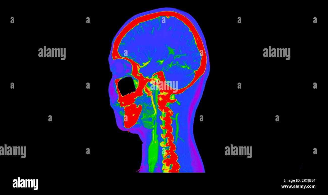 CT angiography of the brain or CTA brain and neck Sagittal view 3D ...