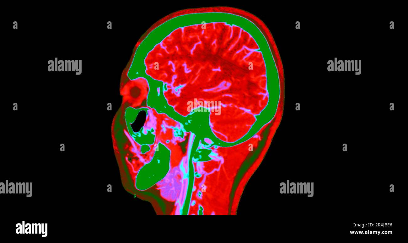 CT angiography of the brain or CTA brain and neck Sagittal view 3D ...