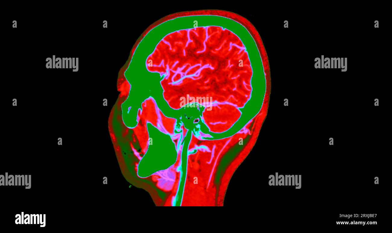 CT angiography of the brain or CTA brain and neck Sagittal view 3D ...
