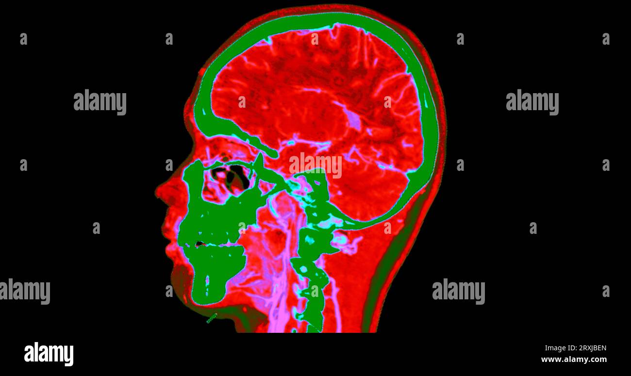 CT angiography of the brain or CTA brain and neck Sagittal view 3D ...